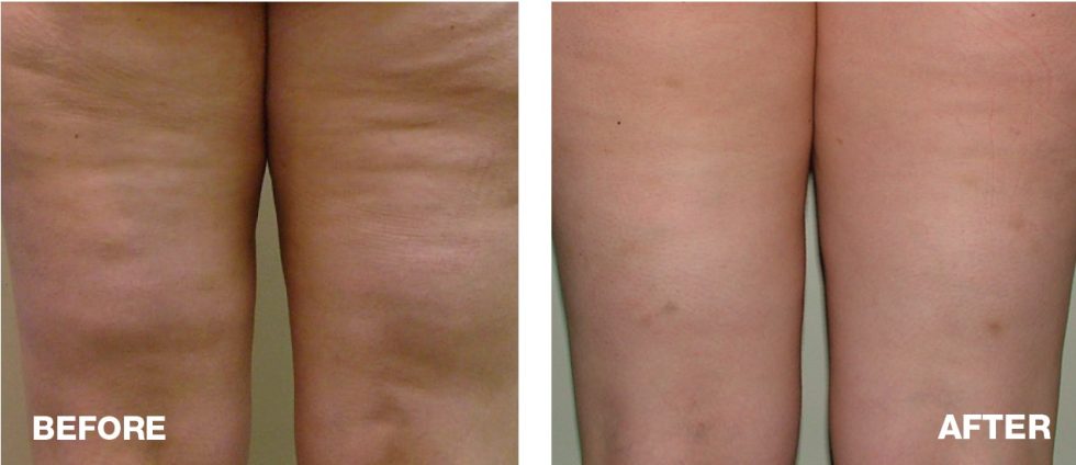 The Benefits of Cellulite Treatment with VelaShape III