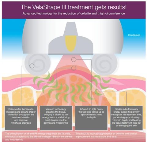 The Benefits of Cellulite Treatment with VelaShape III